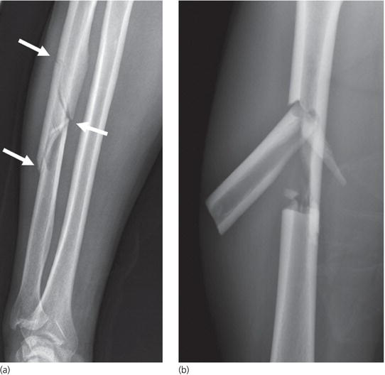 Imaging Musculoskeletal Trauma