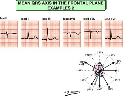 CARDIAC AXIS INTERPRETATION BASICS OF ECG, 59% OFF